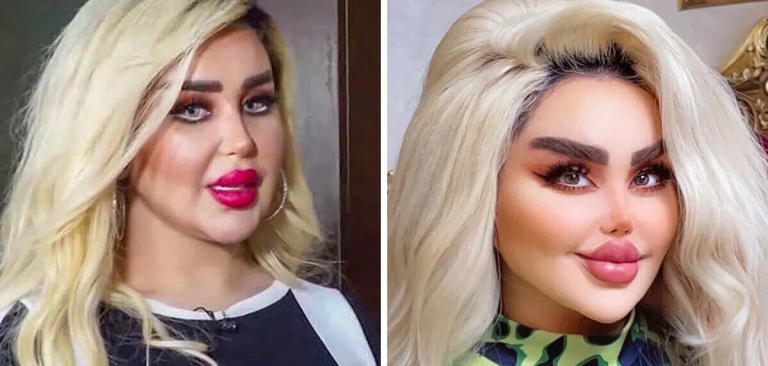 Incredible Transformation: Woman Undergoes 43 Plastic Surgeries!